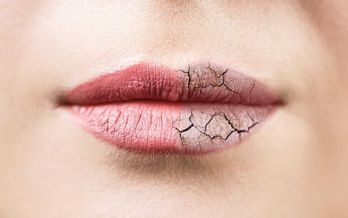 Hidragloss: conheça o tratamento para hidratação e rejuvenescimento labial