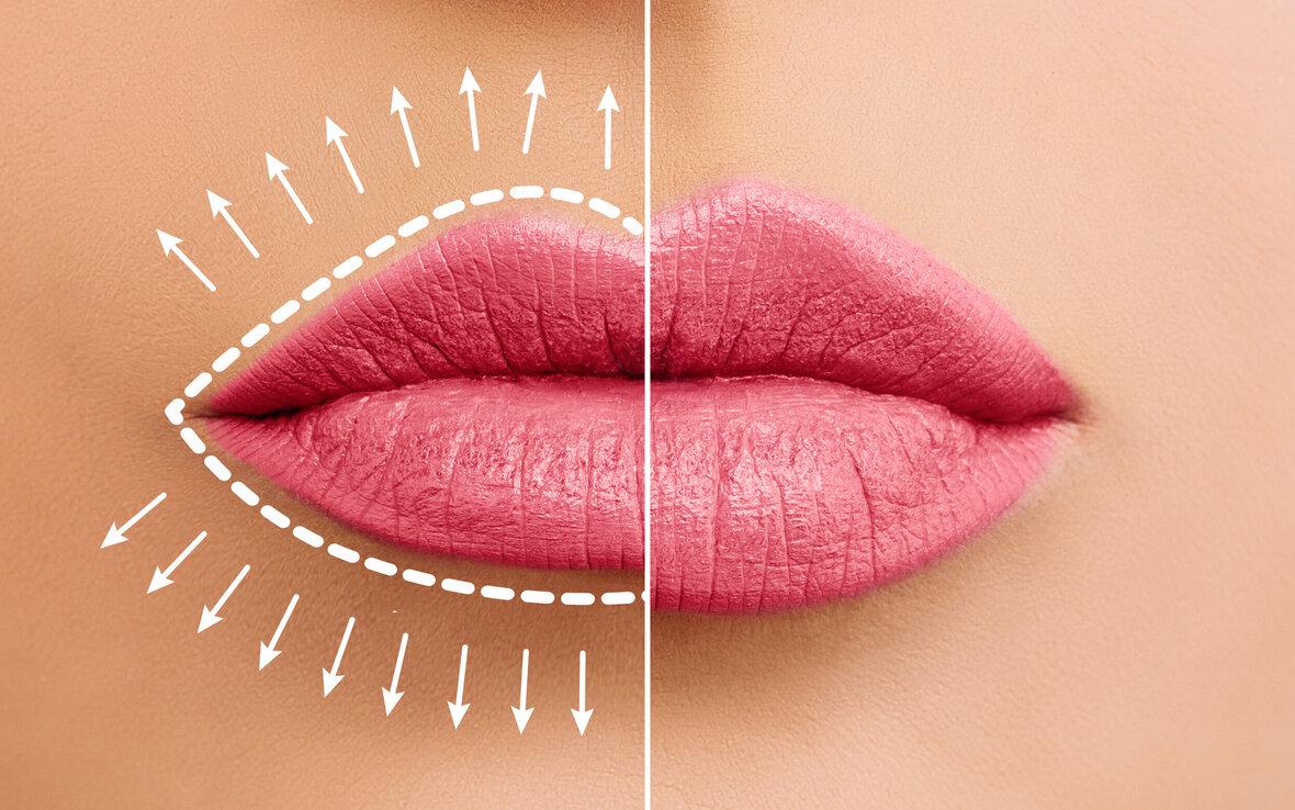 Hidragloss: conheça o tratamento para hidratação e rejuvenescimento labial